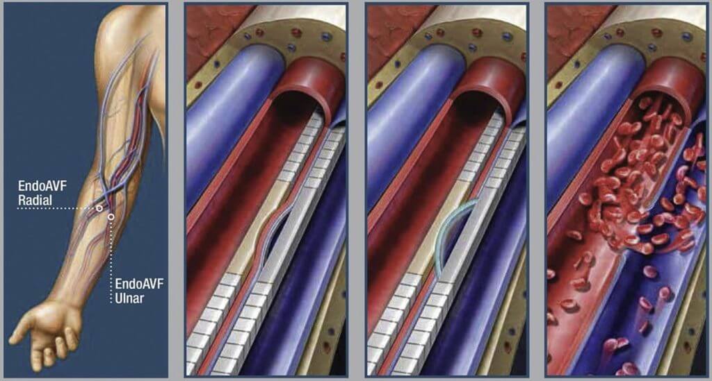 Endovascular AVF creation | Dr Jason Toniolo